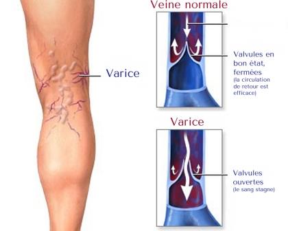 A quoi servent les valvules ? - La Boutique des Jambes